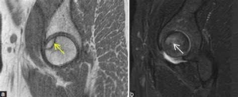 Avascular Necrosis Of Femoral Head And Its Mimics A Comprehensive