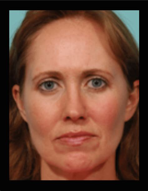Midface Suspension Beeson Cosmetic Surgery