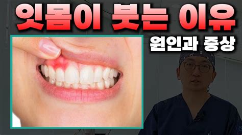 잇몸은 왜 부을까ㅣ잇몸이 붓는 이유 Youtube
