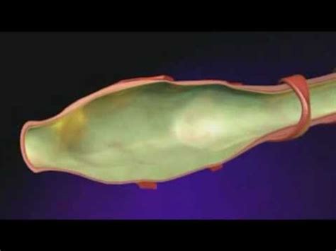 Dilatation Des Bronches Bronchectasie Youtube