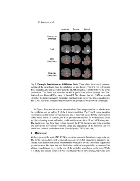 A Joint Graph And Image Convolution Network For Automatic Brain Tumor