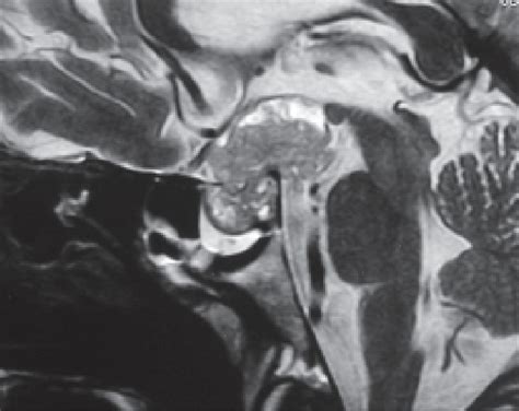 Sagittal T 2 Weighted Image Showing A Lobulated Heterogeneously