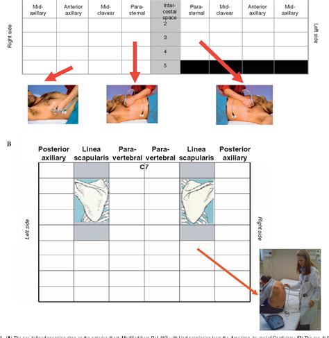 Figure 1 From Ultrasound Lung Comets In Systemic Sclerosis A Chest