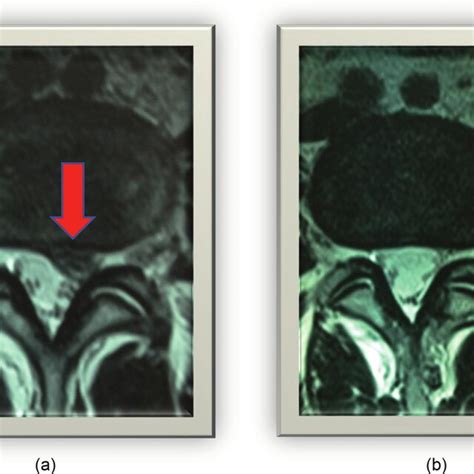 Meyerding S Classification Uses As A Criterion The Degree Of Sliding Of