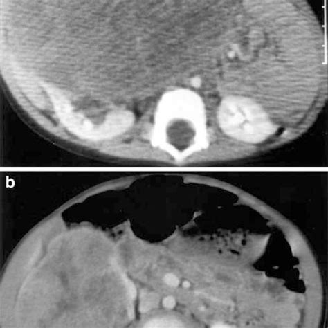 A Patient No 2 Initial Tumor Volume 1 346 Ml B Patient No 2