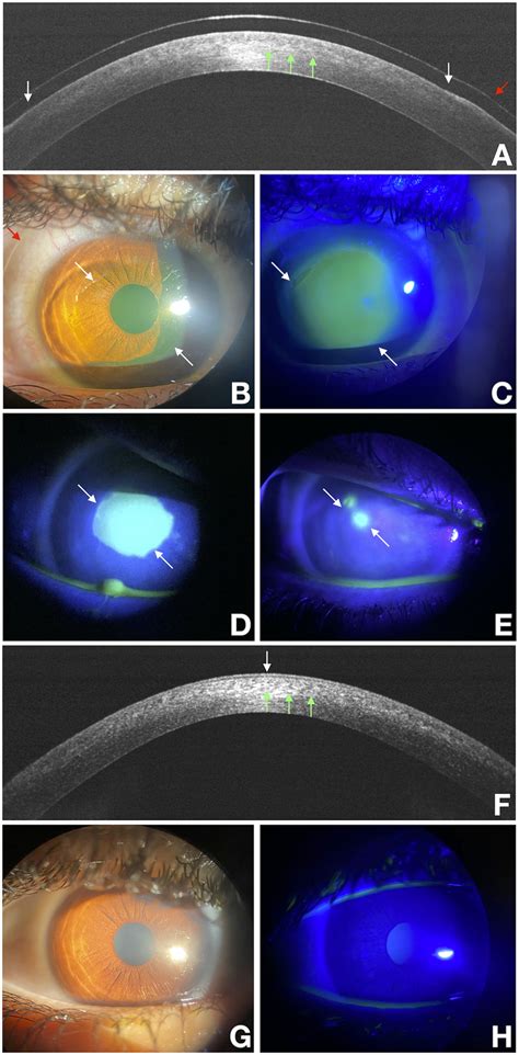 Delayed Re Epithelialization After The Epithelium Off Cxl Epi Off Cxl Download Scientific