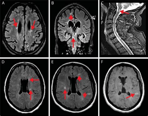 Examples Of Typical Ms Mri Findings Download Scientific Diagram
