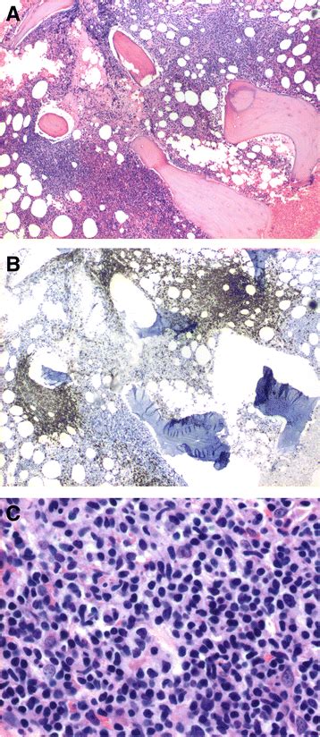 Bone Marrow Involvement By T Cell Lymphoma A Paratrabecular And