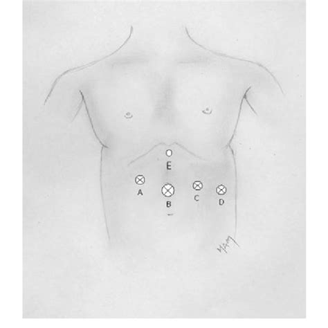 Thoracoscopic Port Site Placement For MIO Prone Position A C Mm