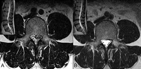 A Preoperative T2 Weighted T2w Axial View Magnetic Resonance Imaging