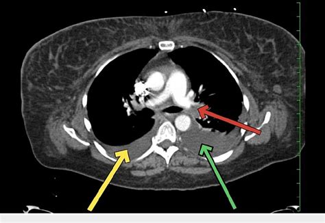 Figure 1 From Right Atrial Thrombus And Submassive Pulmonary Embolism