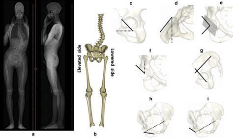 A Full Body Biplanar X Rays For A Patient With Adolescent Idiopathic