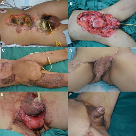 A View Of Abdominal Wall And External Genitalia After High Voltage Download Scientific Diagram