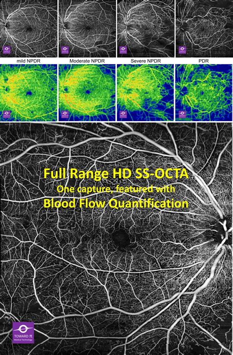 Oct Octa Ophthalmology Ssoct Towardpi
