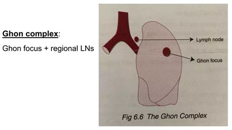 Tuberculosis Pleural Effusion Pathology Nursing Pptx