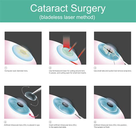 Explain Different Types Of Cataract Surgery