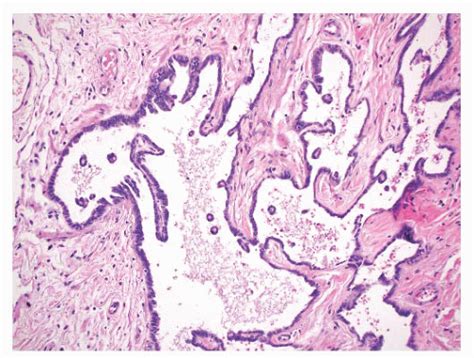 Epididymal Cyst Histology