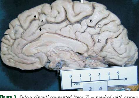 Structure Of Subparietal Sulcus Semantic Scholar Structure Of Subparietal Sulcus Semantic Scholar