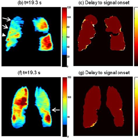 A Graphical Representation Of Collateral Ventilation Adapted From Hogg Download Scientific