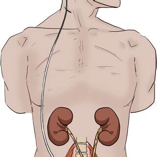 Ventriculoureteral Shunt Without Nephrectomy Download Scientific Diagram