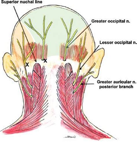 Peripheral Nerve Blockade Anesthesia Key