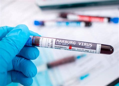 Otro Brote Se Detectan Casos Del Virus De Marburgo En Ghana