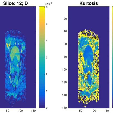 Example Of A Tridimensional ADC Map For Patient 1 Download Scientific Diagram