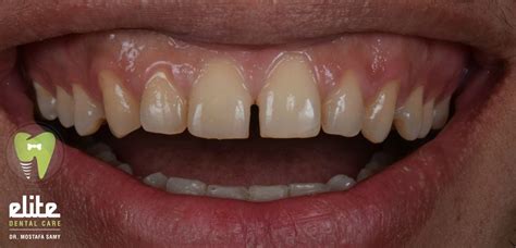 Class Iv Composite Restoration