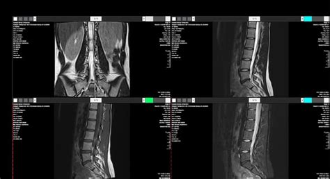 Mri Of Lumbar Spine Rsciatica