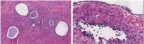 Clear Cell Adenocarcinoma Ovary