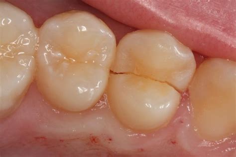 Cracked Tooth American College Of Prosthodontists