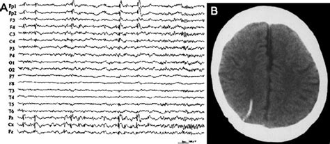 Case 8 A Interictal Eeg A1a2 Reference Demonstrating Frequent Download Scientific Diagram