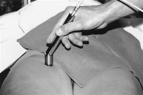 Level Of Radioactivity Measured Over The Presumed Sentinel Node Site Download Scientific