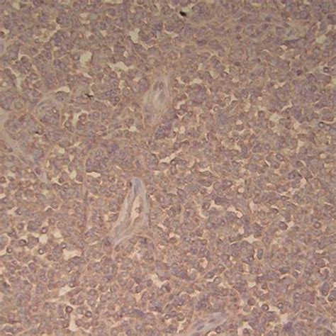 Immunohistochemical Staining Revealed Weak But Diffuse Positivity For