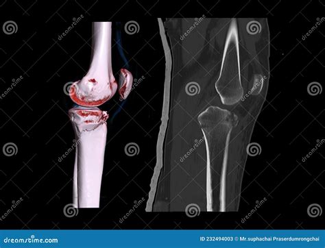Compare Of Ct Knee Joint 3d Rendering Image Lateral View And Ct Knee 2d Sagittal View Isolated