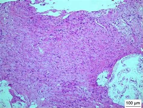 Histologic Examination Showing Abundantly Glial Cell Composition With