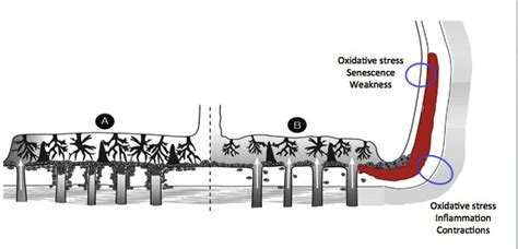 Figure 1 From The Cytotrophoblastic Shell And Complications Of