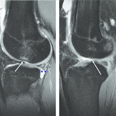 A Optimal Placement Of Tibial Tunnel Posterior To The Blumensaats Download Scientific