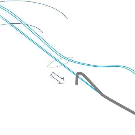 The Needle Retrieves The Suture Loop And The Viper Is Extracted From