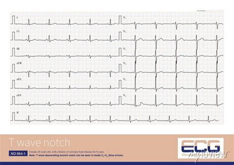 When The Repolarization Desynchronization Difference Between Posters For The Wall • Posters Beat