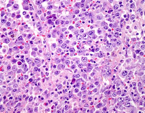 Diffuse Large B Cell Lymphoma Light Micrograph Stock Image C057 7075 Science Photo Library