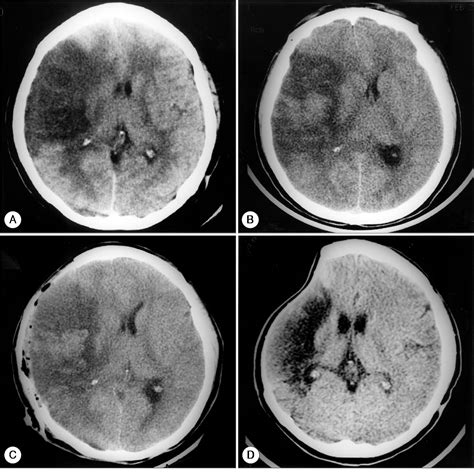 Figure 1 From Clinical Analysis Of Decompressive Craniectomy For Acute