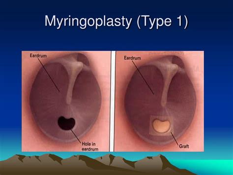 Ppt Myringotomy Powerpoint Presentation Id3956149
