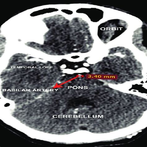Axial Source Image Of Computed Tomography Angiography Of Brain Showing