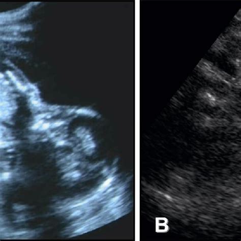 Prenatal Ultrasound Showing Bilateral Enlarged Echogenic Lungs With