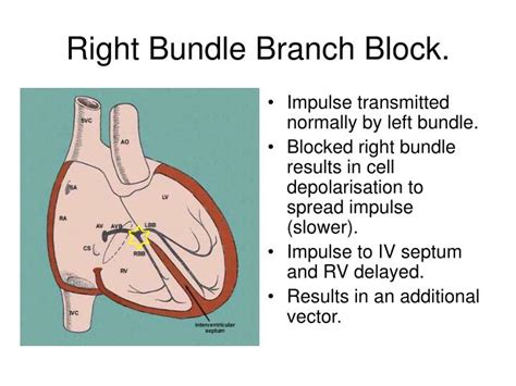 Bunny Ears Right Vs Left Bundle Branch Block