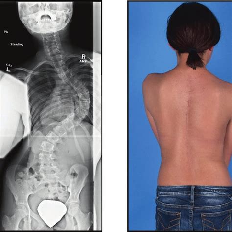 Adult Idiopathic Scoliosis