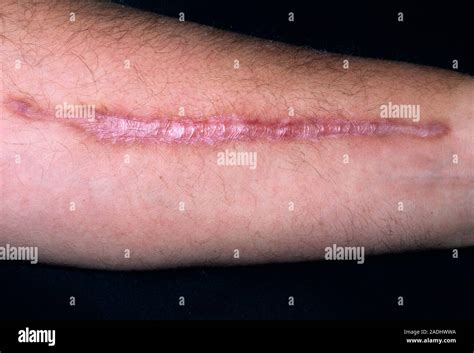 Keloid Scar On The Forearm Of A 57 Year Old Male Patient Following An