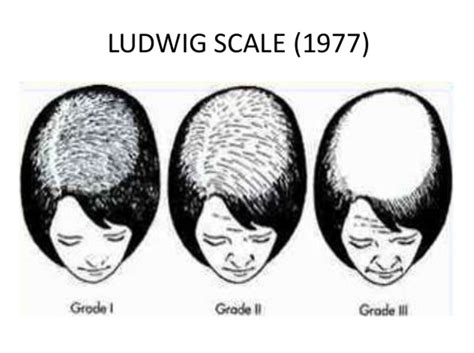 Types Of Hair Loss In Toronto On By Freedomclinic