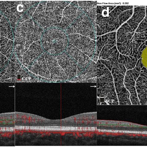 Macular Vd And Faz Area Measurement The Image Above Is Octa The Download Scientific Diagram